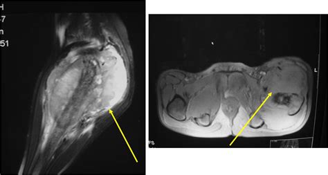 Ewing Sarcoma Bone Tumor Cancer Tumors Of The Bone