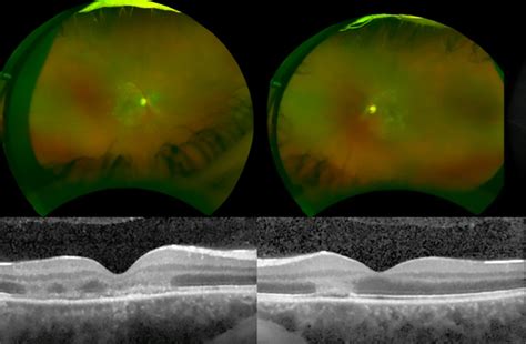 Acute Posterior Multifocal Placoid Pigment Epitheliopathy Apmppe
