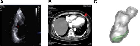 Risk Factors For In Hospital Systemic Thromboembolism In Myo Medicine