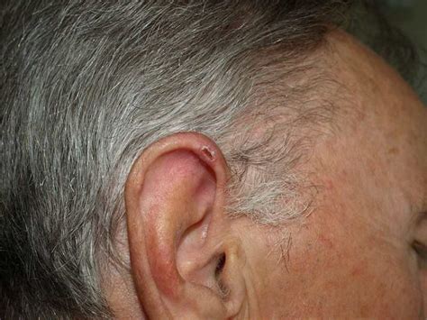 Chondrodermatitis Nodularis Helicis Contour Dermatology