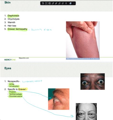 Endo Hyperthyroidism Exam 2 Flashcards Quizlet
