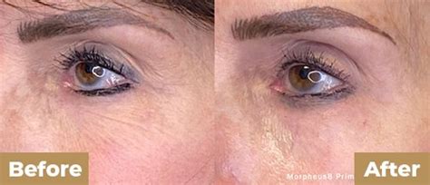 Morpheus8 Skin Tightening Rf Microneedling For Face And Body The Prp