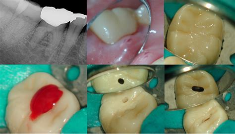 Lower Molar Wsinus Tract On A Recently Placed Crown Tdo University