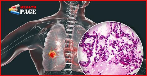 Micropapillary Lung Adenocarcinoma Is The Most Dangerous Pathological