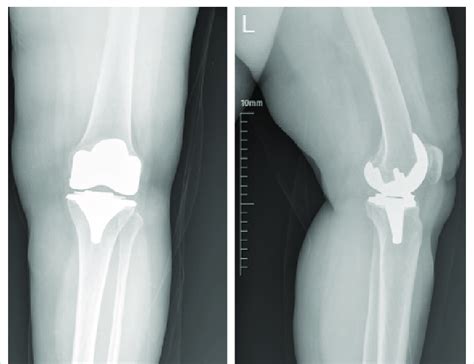 Prosthesis Control With Anteroposterior And Lateral Knee Radiographs