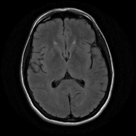Radiopaedia Case Perivascular Space Tumefactive Id 68483 Study