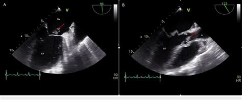 Transesophageal Echocardiogram Tee Images Demonstrating A Large