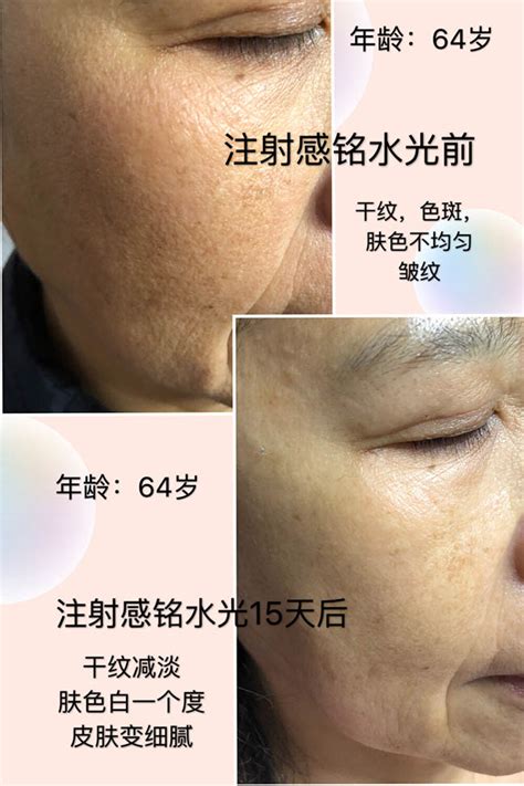 Hycoox Injector 韩国海库斯全自动负压水光机 Wassup Apgujeong Korean Skin Care Reviews