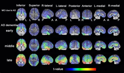 Table 1 From Voxel Based Morphometry Of Brain Mri In Normal Aging And Table 1 From Voxel Based Morphometry Of Brain Mri In Normal Aging And