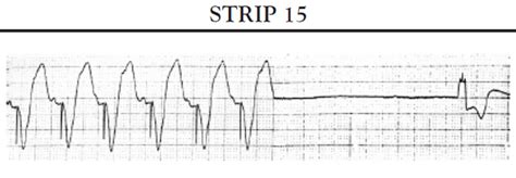 Pacemaker Failure To Capture