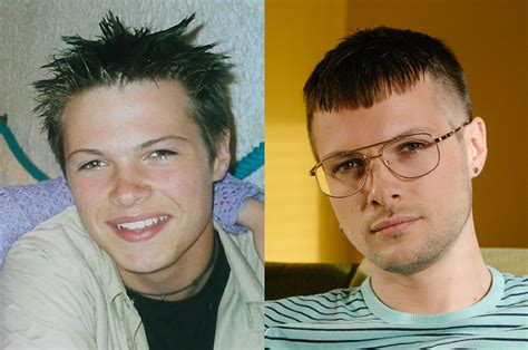 Hiv Patient Before And After