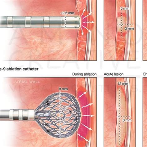 Affera Sphere 9 Ventricular Ablation Comparison Illustration By Amino
