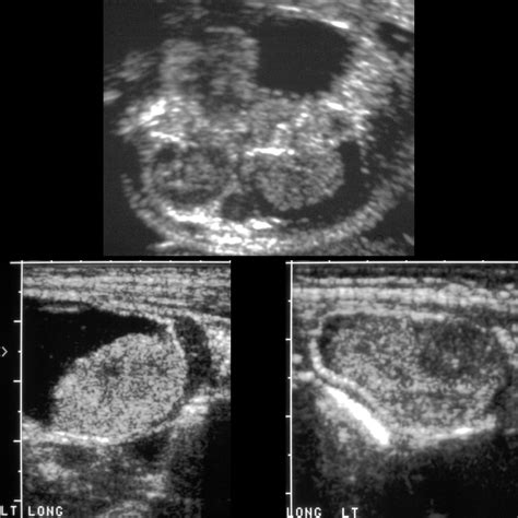 Pediatric Ovarian Torsion Pediatric Radiology Reference Article
