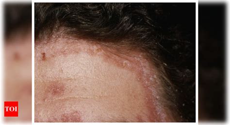 Psoriasis Leads To Risk Of Co Morbidities Say Doctors Chennai News
