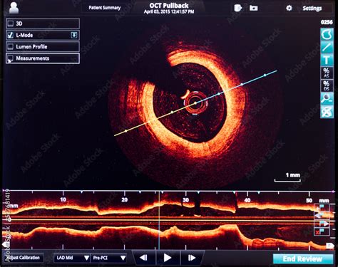 Intravascular Optical Coherence Tomography Oct Image Angiography