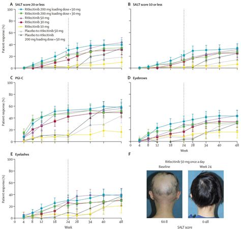 Ritlecitinib Litfulo™ For Alopecia Areata Benefits Risks And Hair