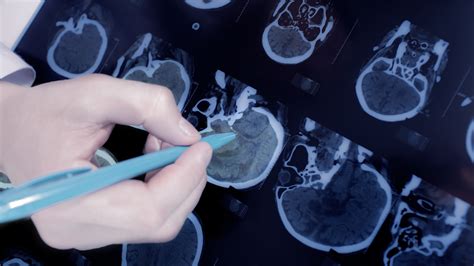 Estudo Mostra Melhora De Parkinson Em Pacientes Com ‘marcapasso