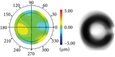 Slit Lamp Examination Of The Ohb Before A And After Bleb Excision C