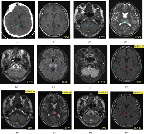 Acute Encephalopathy Semantic Scholar