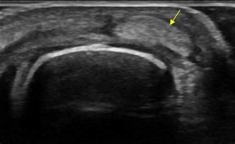 Musculoskeletal Joints And Tendons Wrist And Carpus Case Trauma Of The Tendons