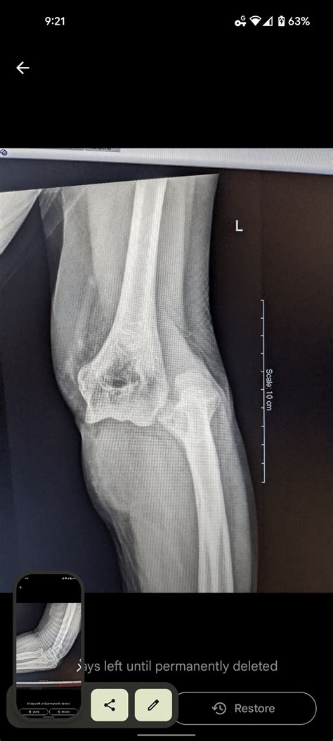 Before You Criticize My Lateral Elbow Check Out The Ap Get Both Views People R Radiology