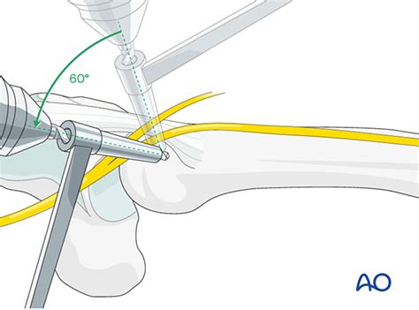 Intramedullary K Wire Fixation For Extraarticular Fracture Of The Distal End Segment