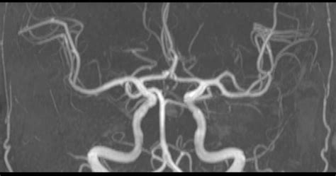 Anterior Cerberal Artery Fenestration Radiology Case Radiopaedia