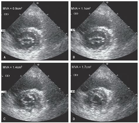 Mitral Valve Disease Thoracic Key