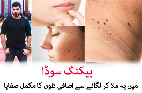 Face Mole Khatam Karne Ka Tarika
