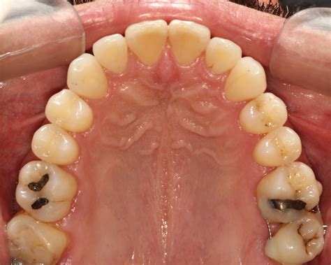 Case Gallery Clearcorrect