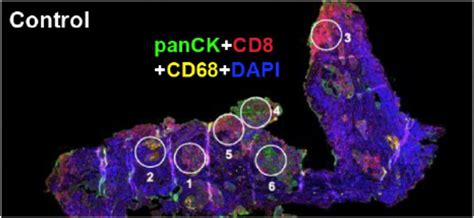 Thin Tissue Slice Of Lung Cancer Digital Signal Processing Adjacent Download Scientific
