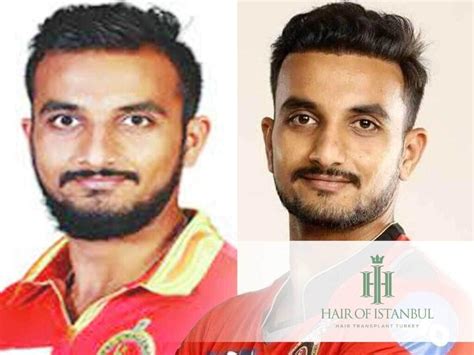 Harshal Patel Hair Transplant Analyzing His New Look