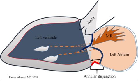 Mitral Annular Disjunction Review Of An Increa
