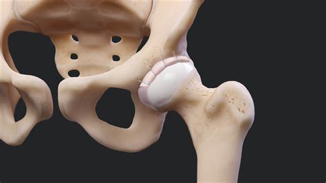 Arthrex Labral Fixation