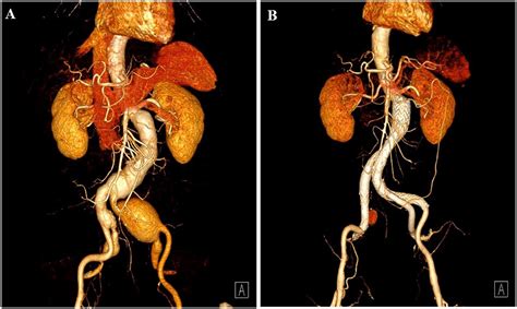 Midterm Results Of A Surgeon Modified Device To Preserve The Flow Of