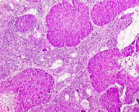 Photomicrograph Showing Tongue Squamous Cell Carcinoma Grade Ii Oral