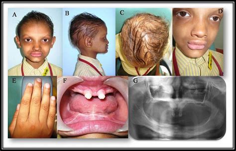 Ectodermal Dysplasia Teeth