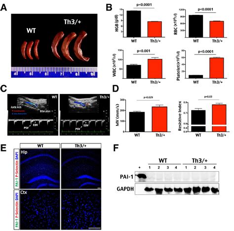Stroke Propensity In The Th3 Mouse Model Of β Thalassemia Intermedia