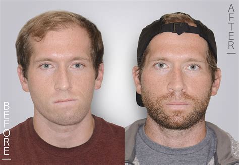 Corrective Jaw Surgery Orthognathic Surgery