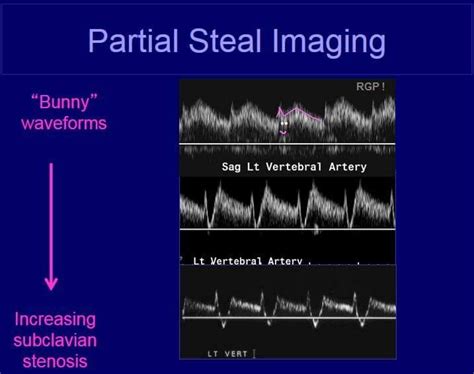 Conejito En Robo De Subclavia Vascular Ultrasound Ultrasound