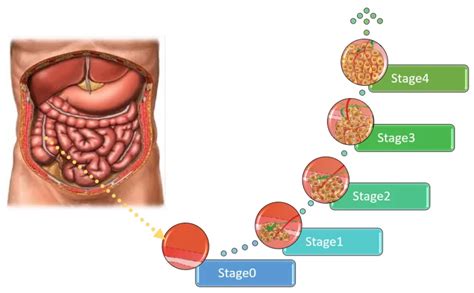 Small Intestine Cancer Universal Hospital