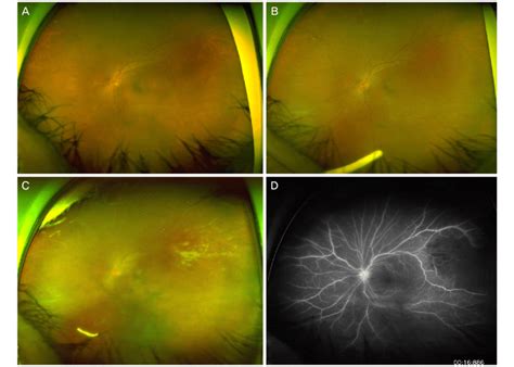Intravitreal Dexamethasone Implantation Was Performed For The Download Scientific Diagram