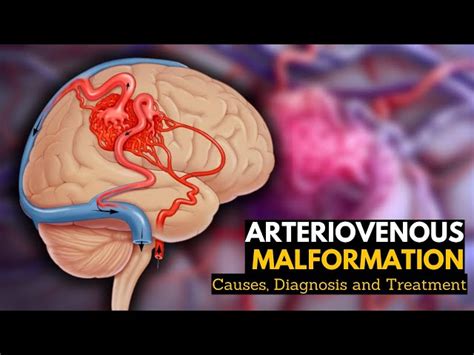Brain Avm Arteriovenous Malformation Symptoms And Human And Mouse