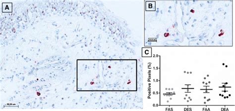 Immunohistochemical Staining Of Tryptase Positive Mast Cells In Human