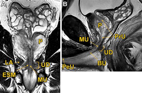 Bulbourethral Gland Vs Cowpers Gland At Kenneth Negron Blog