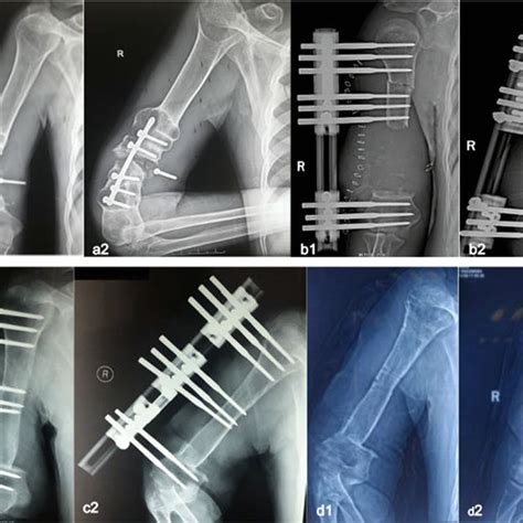 Intramedullary Hybrid Graft A Vascularized Fibular Autograft Inserted Download Scientific