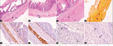 Figure 2 From Segmental Ileal Dilatation Presenting With Neonatal Intestinal Obstruction