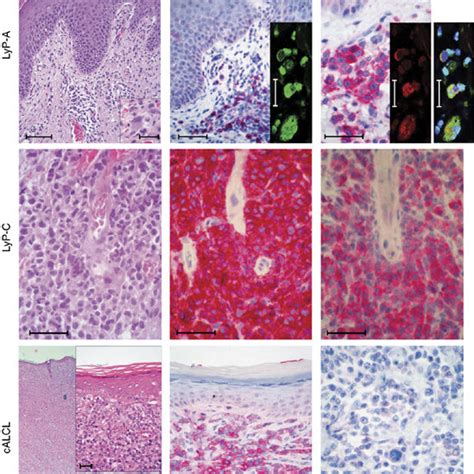 Immunohistological Staining Pattern Of The Ber Traf1a Mab In Cases Of