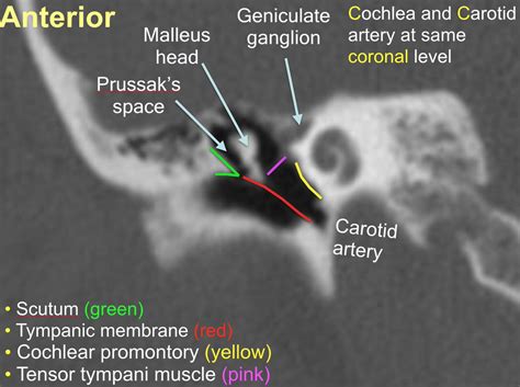 Scutum Temporal Bone