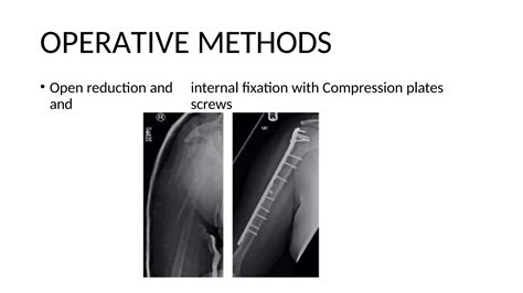 Fracture Of Humerus Shaft And Intercondylar Fracture Pptx